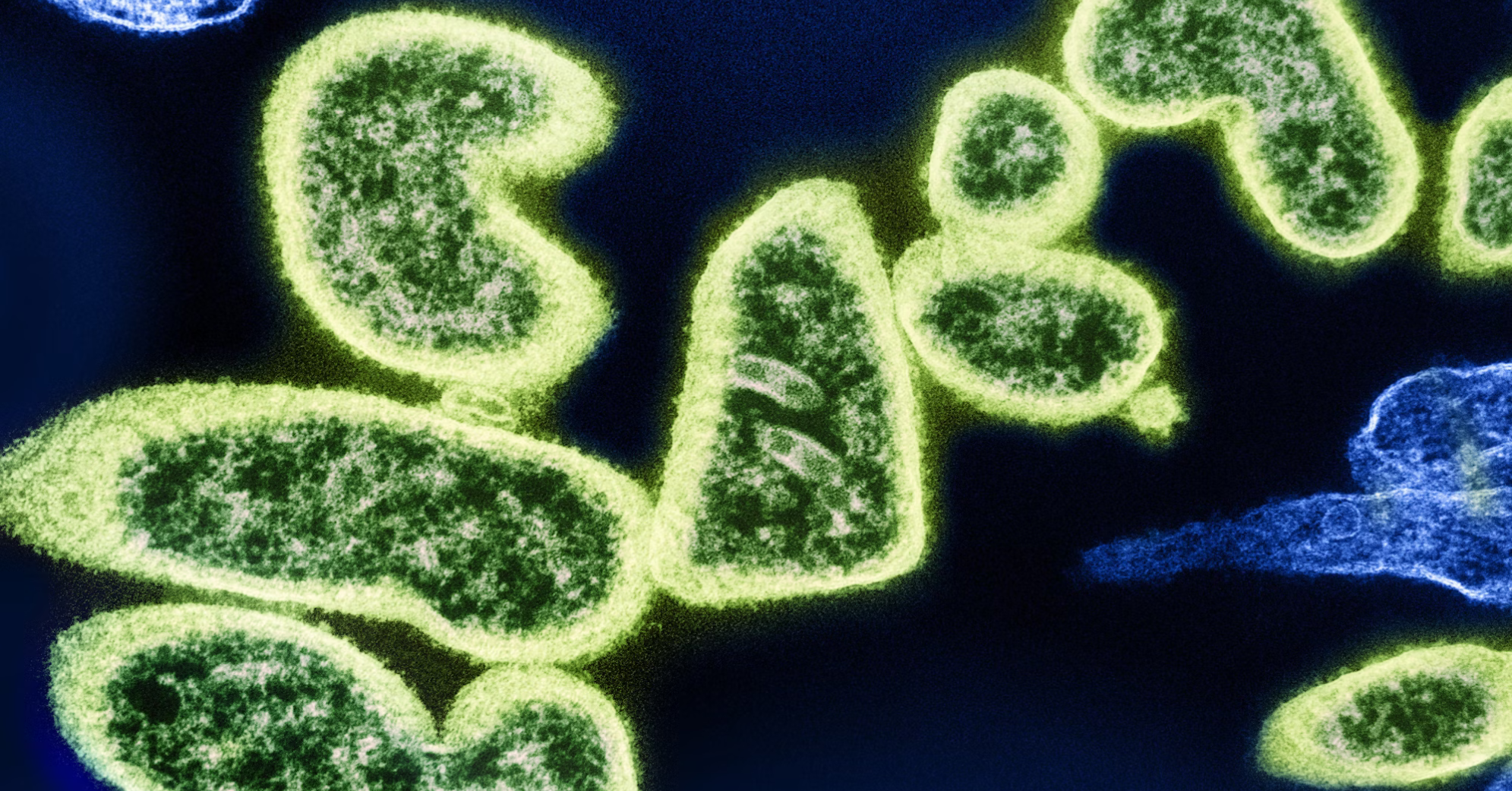 How to Test for Epstein-Barr Virus: What Your Results Really Mean ...